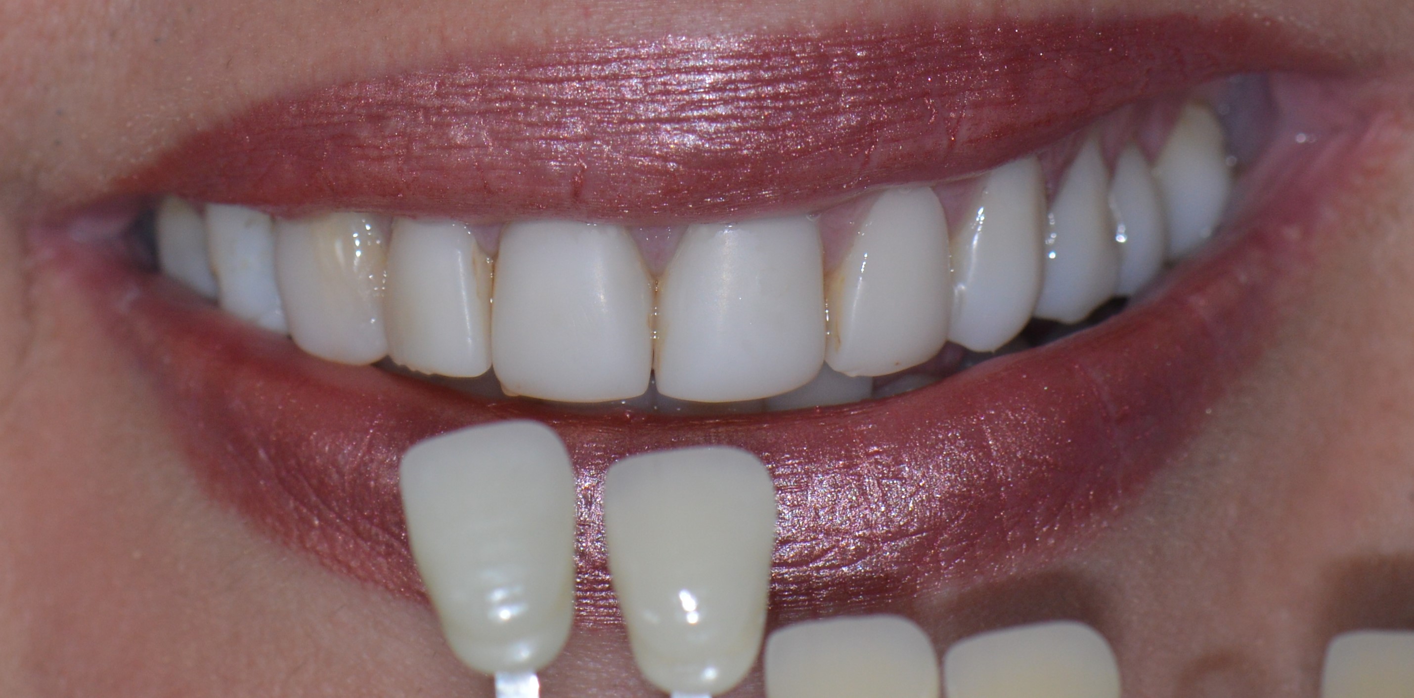 Dental makeover - Αλέξανδρος Παππάς,DDS,B.Sc.